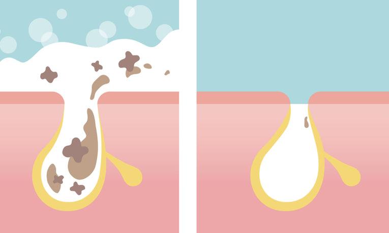 Sebaceous Filaments vs. Blackheads: What’s the Difference and How to B